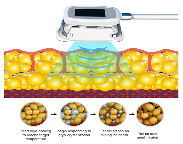 Vertical 4 In 1 Cryolipolysis Fat Freezing Machine - ETG50-8S